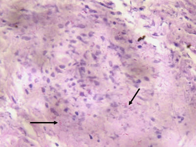 Tuberculosis miliar sistémica | Ferrer Pérez | Acta Médica del Centro