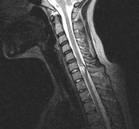 Malformación arteriovenosa cervical. Presentación de una paciente ...